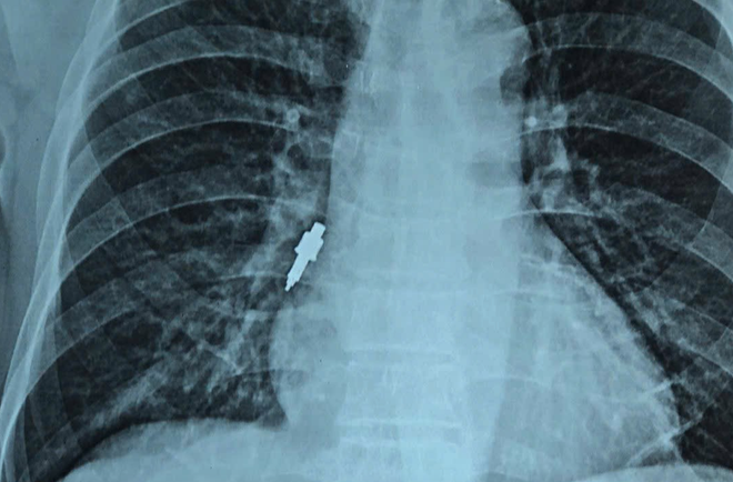Old man with dental foreign body stuck in bronchus after dental implant