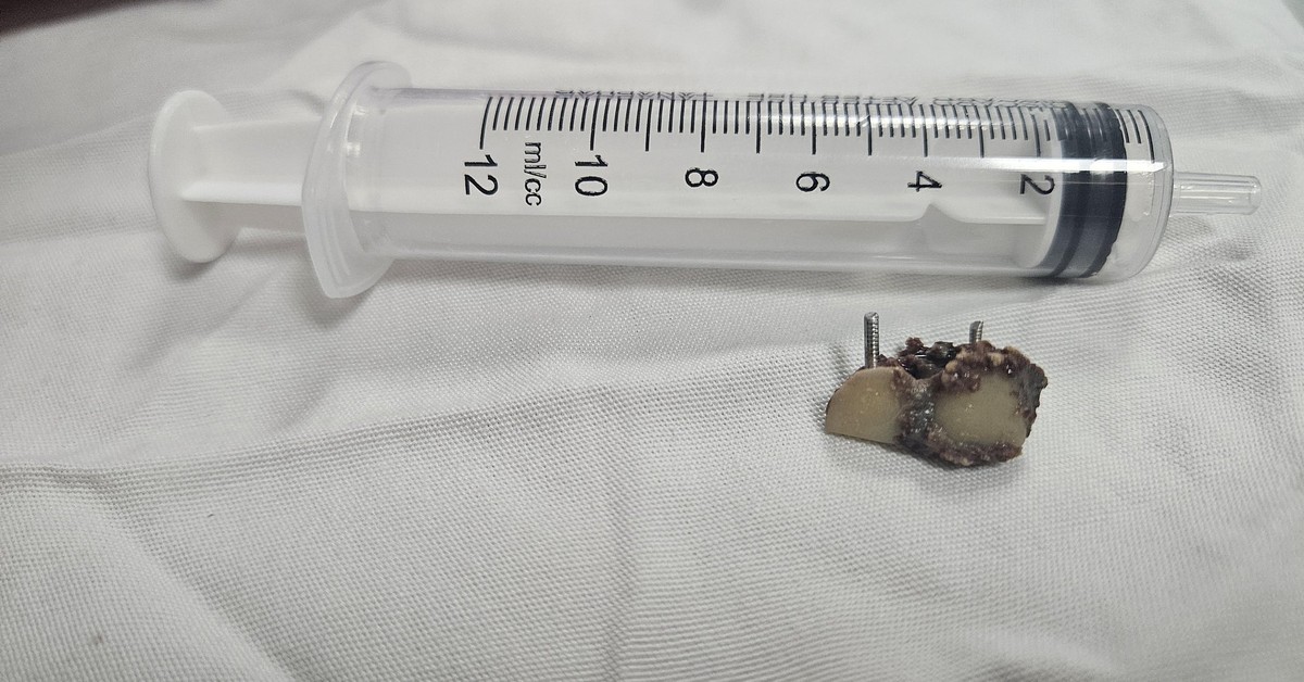 Suddenly losing two teeth, 20 years later doctors discovered them in ...