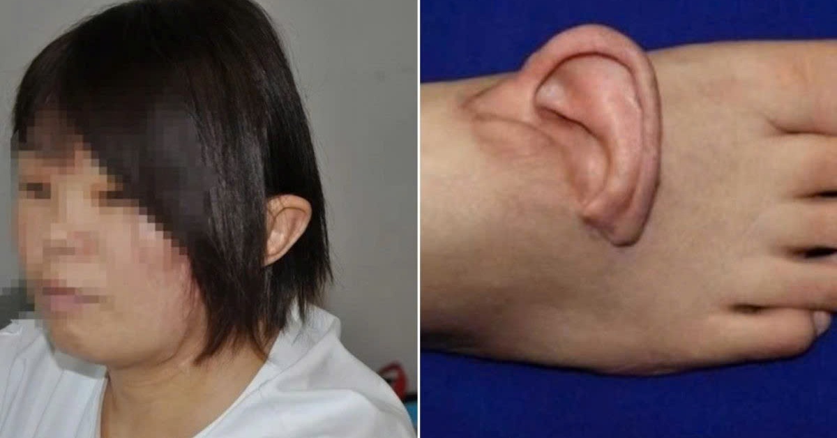 An unprecedented surgery: A severed ear was grafted onto the foot and ...