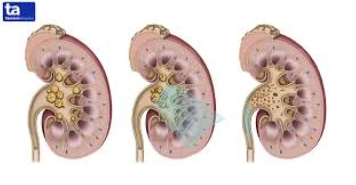 Afrique du Sud : première opération chirurgicale pour retirer un rein d ...