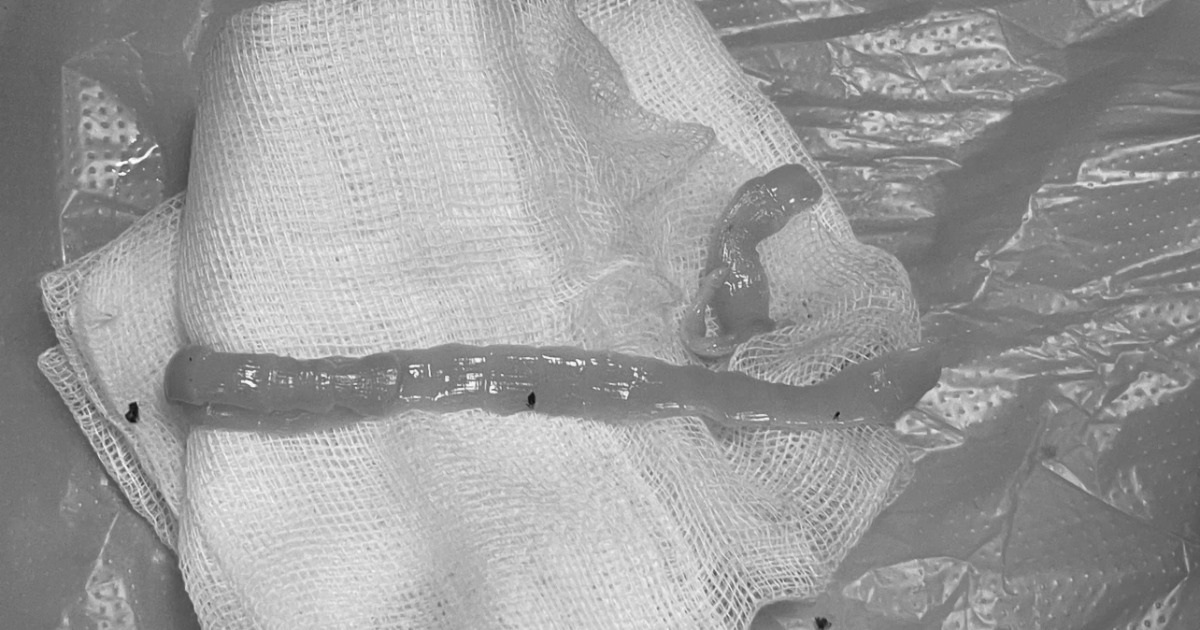 A 1-meter-long tapeworm wriggled in the intestines of a man who enjoyed ...