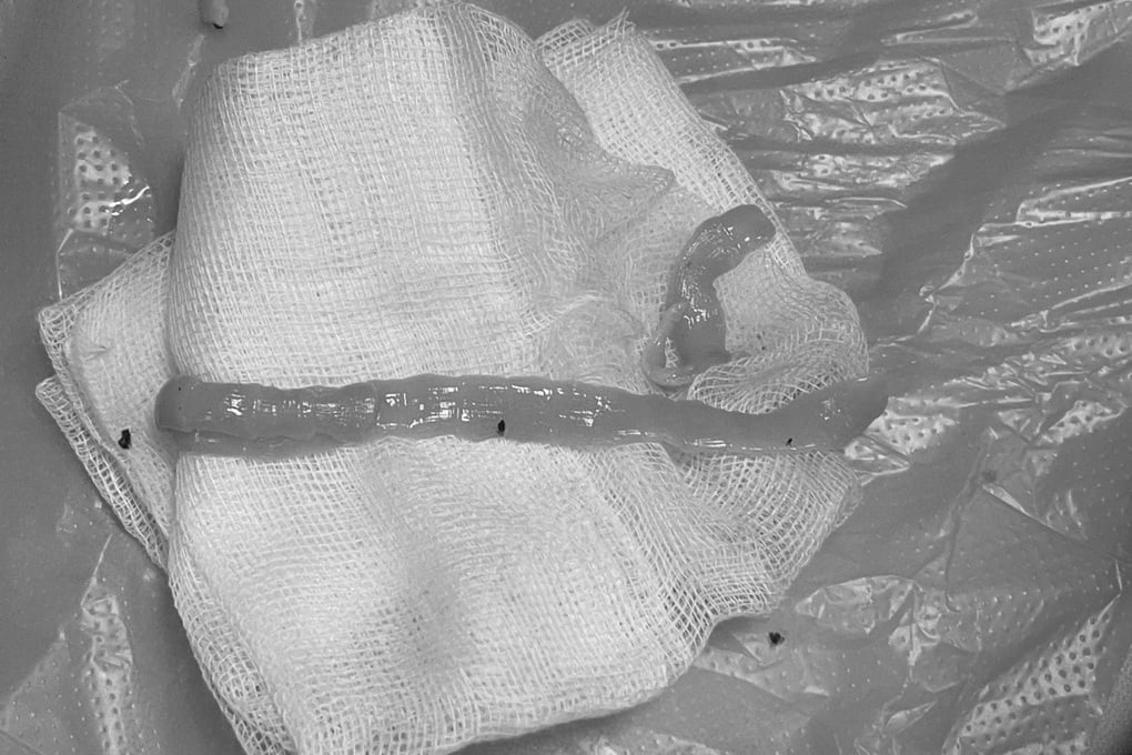 A 1-meter-long tapeworm wriggled in the intestines of a man who enjoyed ...