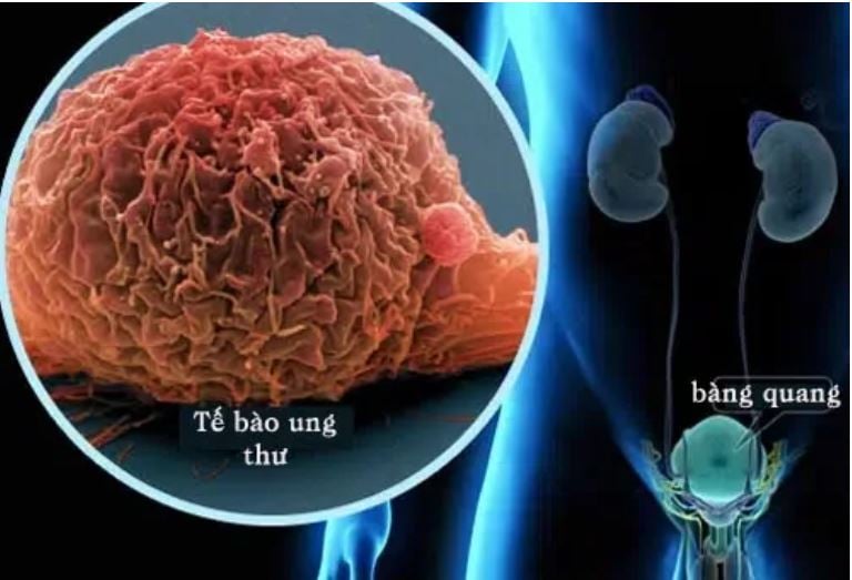 Blood in urine, weight loss... be wary of bladder cancer.