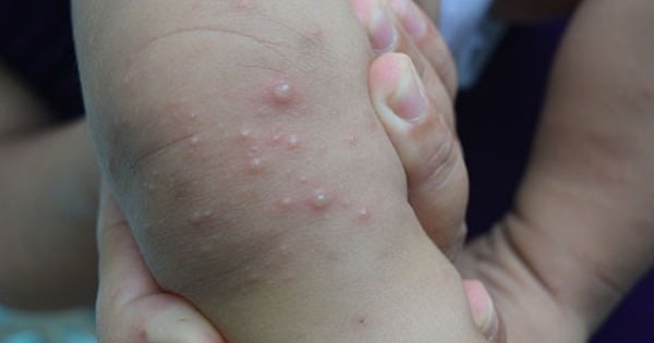 7 ways to prevent hand, foot, and mouth disease in children
