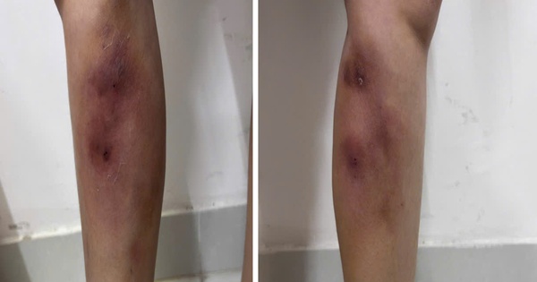 The 29-year-old woman's legs were deformed after she received filler ...