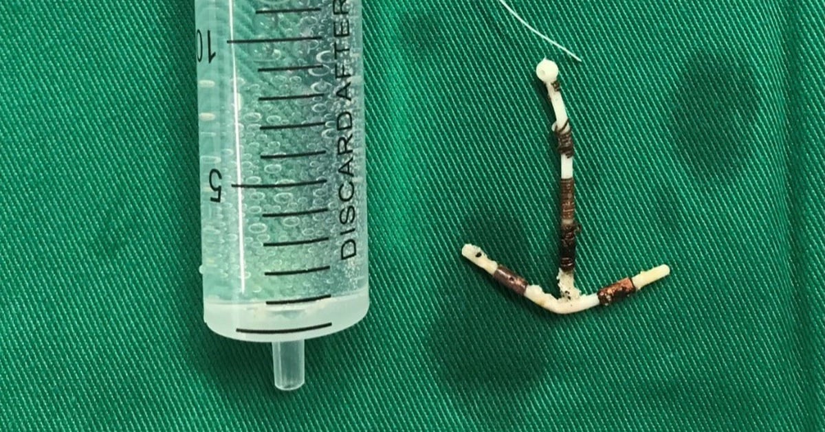 Removing misplaced IUDs over a quarter of a century.