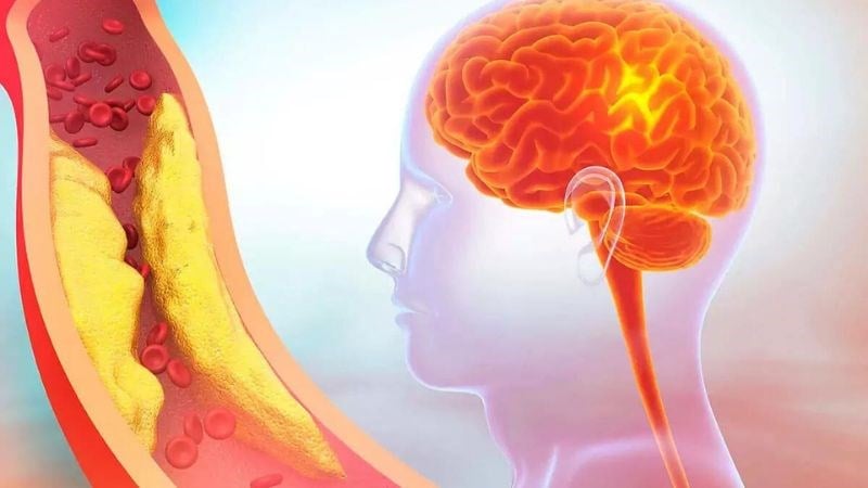 5 dấu hiệu cảnh báo thiếu máu não do hẹp động mạch cảnh